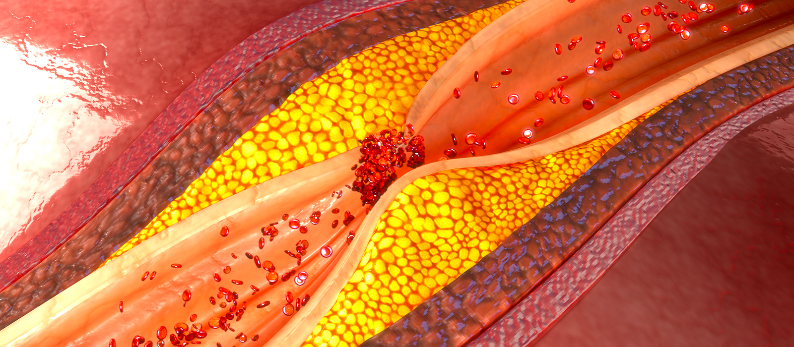 L'athérosclérose - FFC
