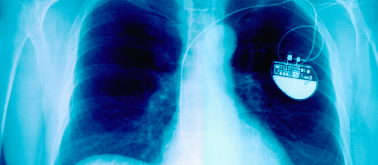 Les troubles du rythme cardiaque, les traitements - FFC