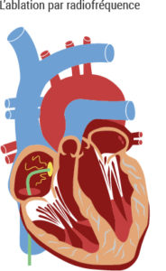 Les troubles du rythme cardiaque, les traitements - FFC