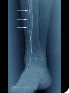 Phlébite : tout savoir sur la thrombose - FFC